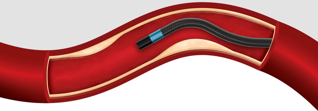 spexLP US - Reflow Medical