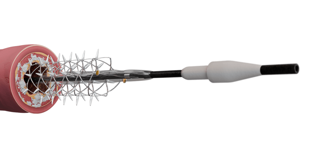 Spur Peripheral Retrievable Stent System | US | Reflow Medical