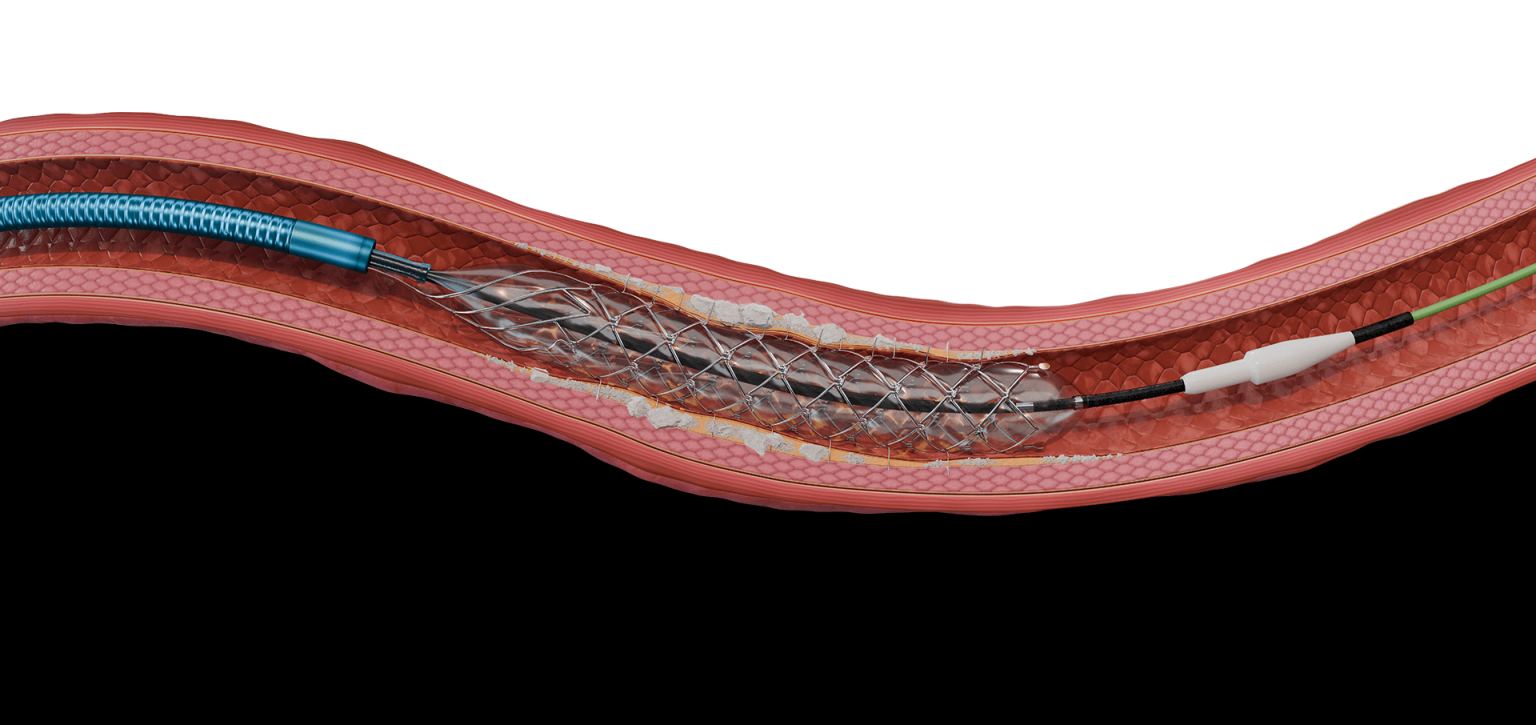 Spur EU - Reflow Medical