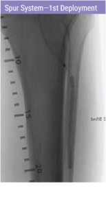 Spur US - Reflow Medical